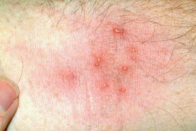 Those red bites on your arm might be Oak Mites - WCPO Cincinnati, OH